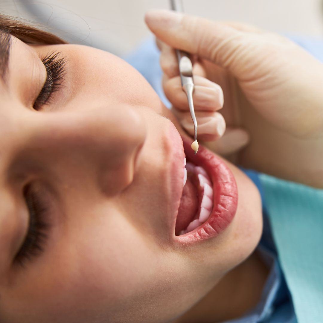 Cuidado Después De Un Empaste Dental ¿qué Debo Comer Clínica Mayo