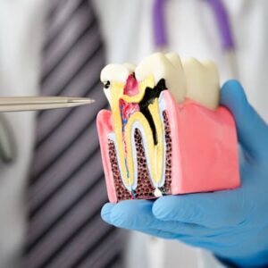 ¿Qué es una endodoncia y cuándo se necesita? | Clínica Mayo Dental